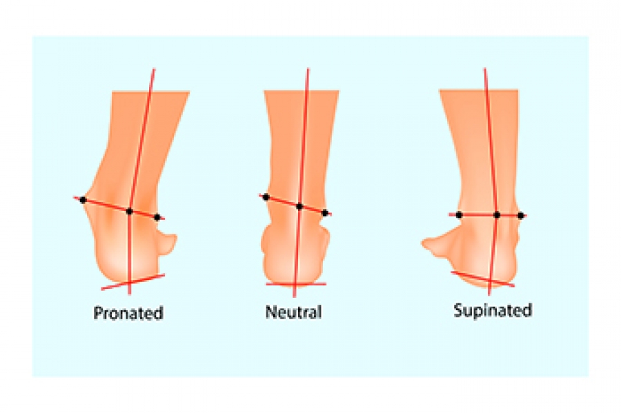 The Link Between Overpronation and Flat Feet