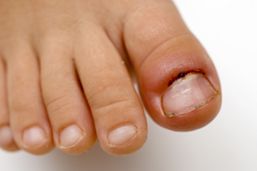 Understanding Toe Infections