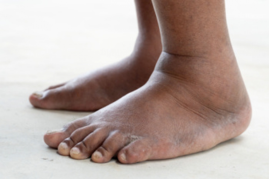 Types and Causes of Swollen Feet